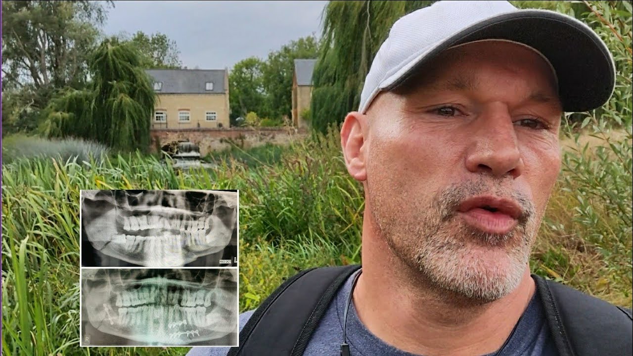 Knuckle Dusters, Jaw Broken , carried on fighting, and then partied for ...