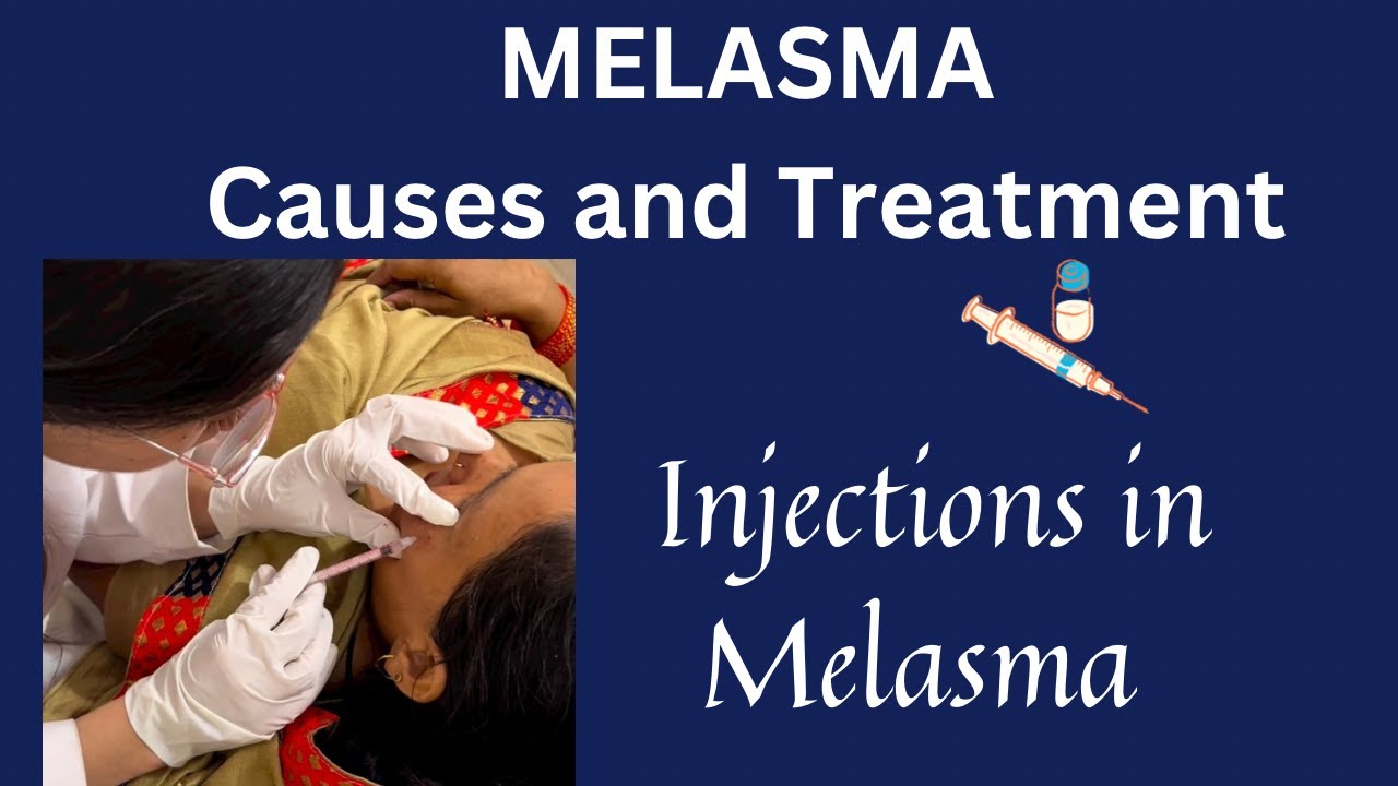 Melasma explained in detail| Causes | Risk factors | Pathophysiology ...