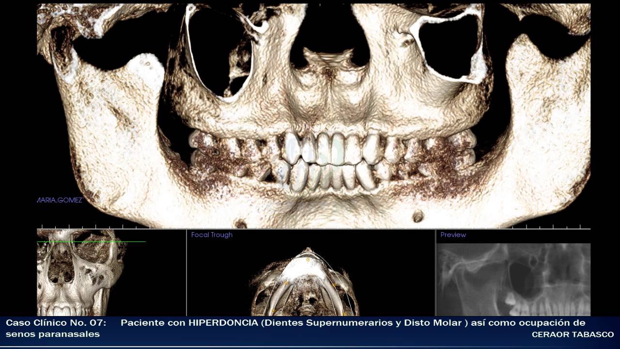 Caso Clínico 07 : Paciente con HIPERDONCIA (Dientes Supernumerarios y ...