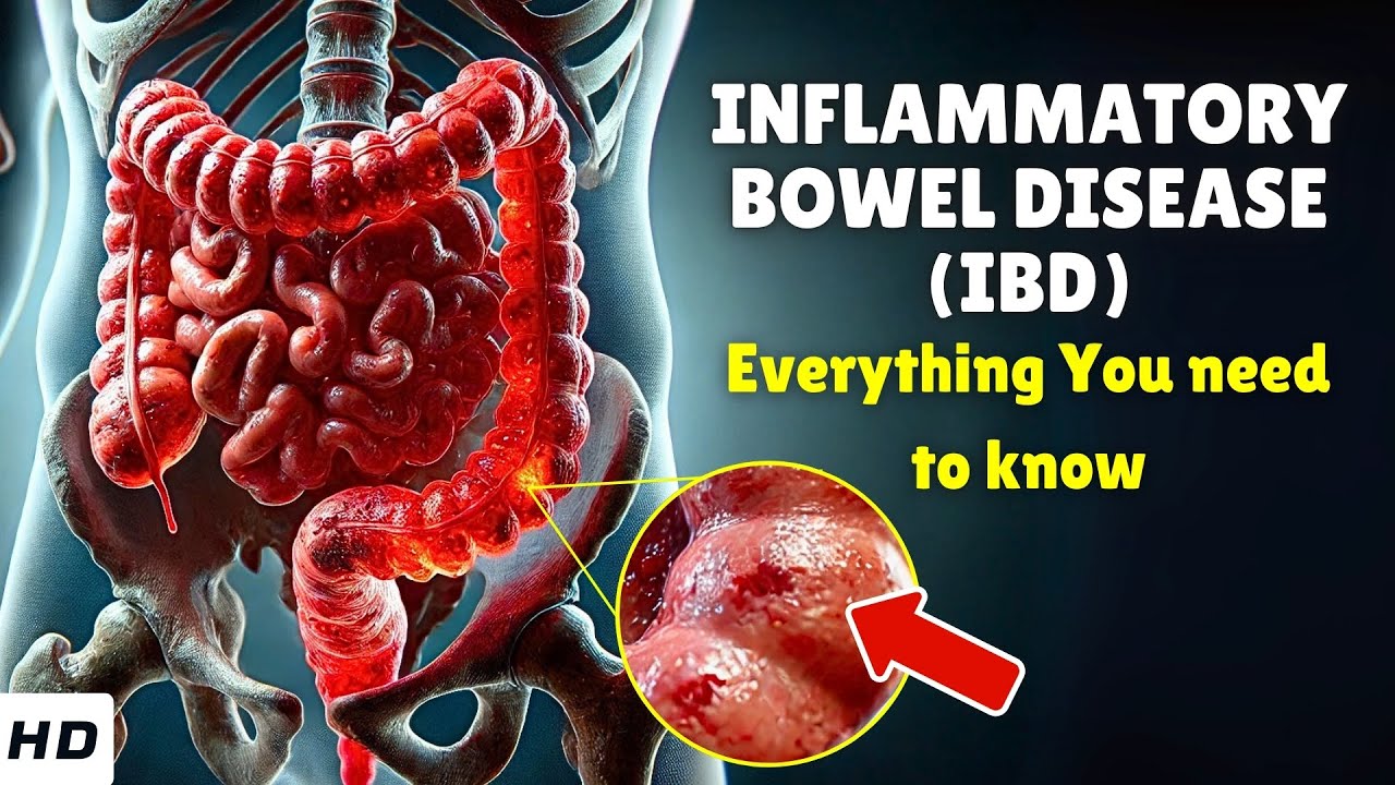 Inflammatory Bowel Disease (IBD) EXPLAINED: Causes, Signs and Symptoms ...