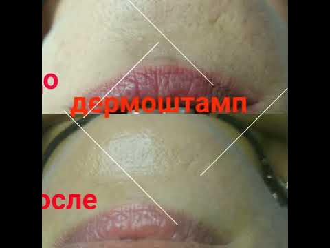 Процедура дермоштамп - YouTube