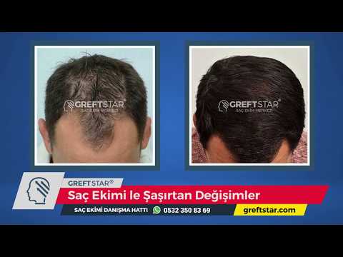 Sac Ekimi Resimleri İle Farkı Yaşayın