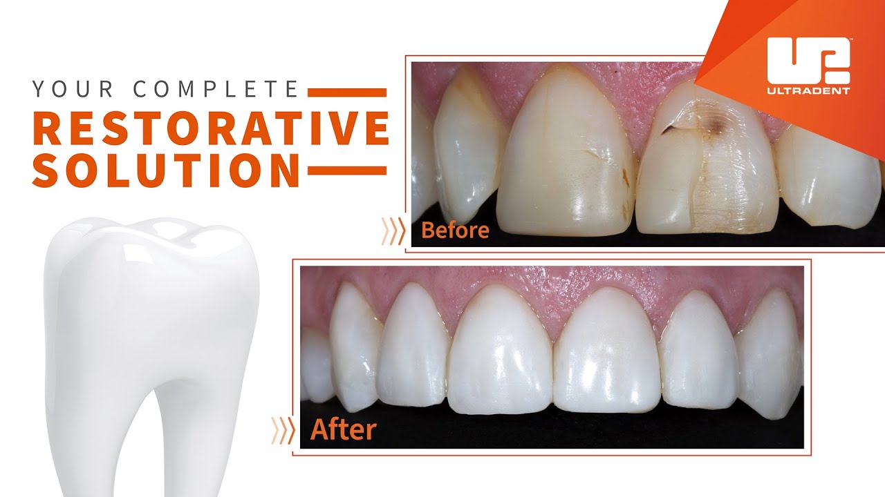 Your Complete Restorative Solution | Ultradent Products - YouTube