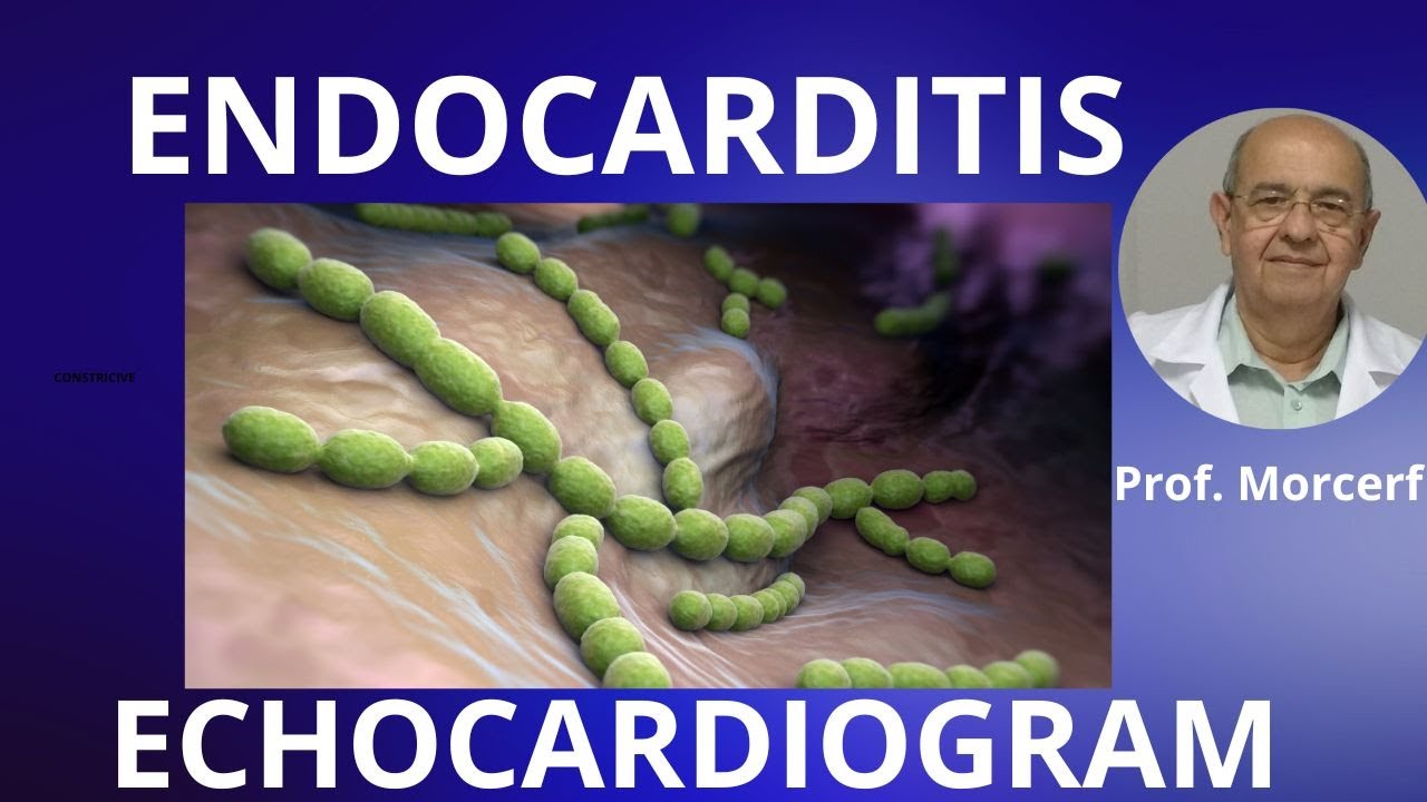 The ultimate guide to Endocarditis Echocardiography. #echocardiography ...