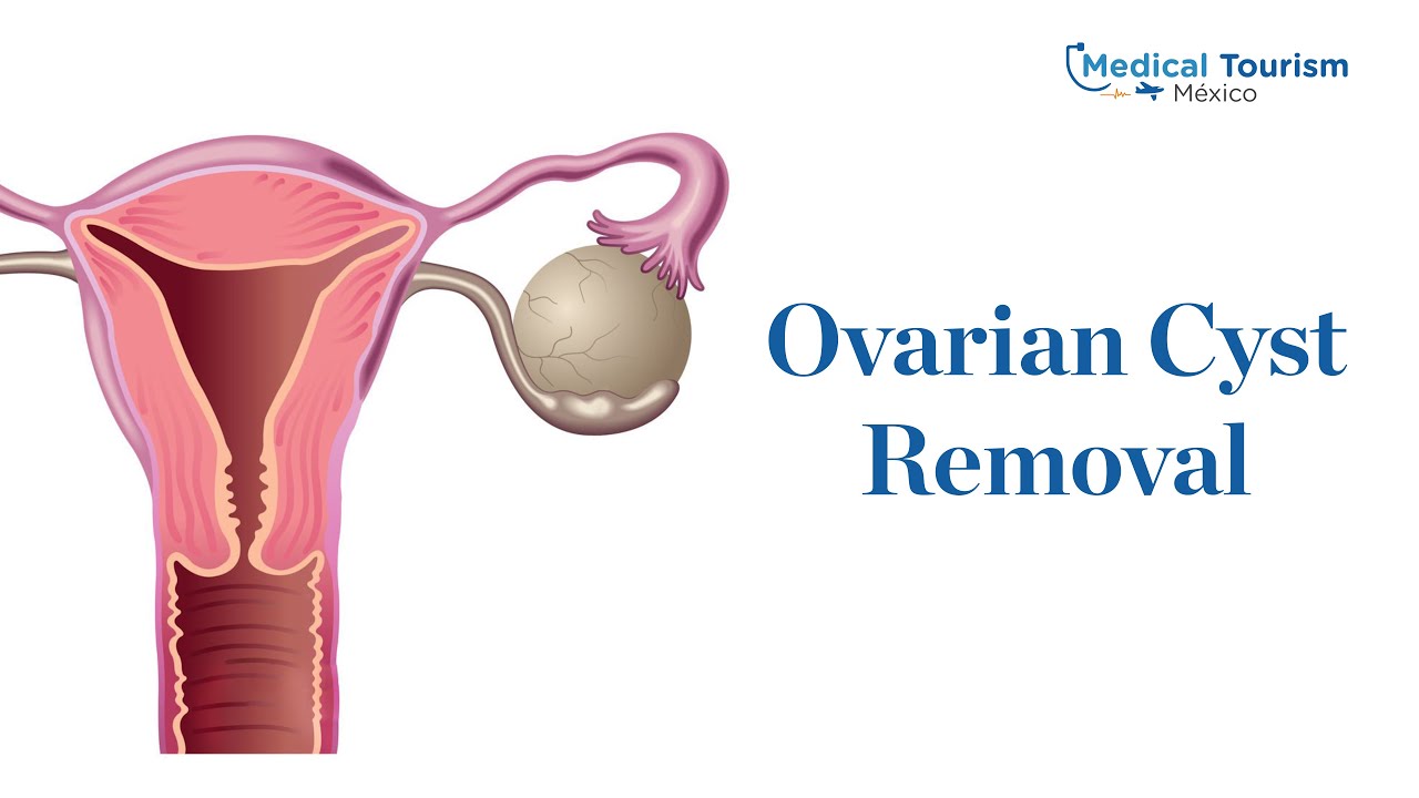 Ovarian Cyst Removal Medical Tourism Mexico Youtube