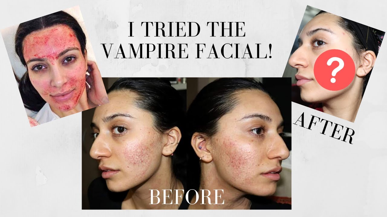 I TRIED THE VAMPIRE FACIAL | PRP - YouTube