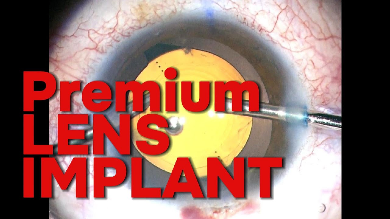 PREMIUM LENS IMPLANT - YouTube