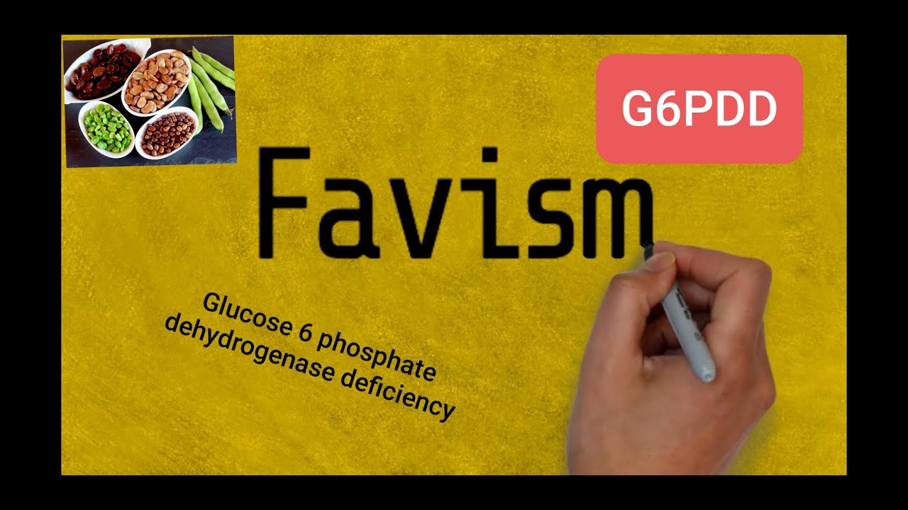 Glucose-6-phosphate dehydrogenase deficiency G6PDD Favism g6pd ...