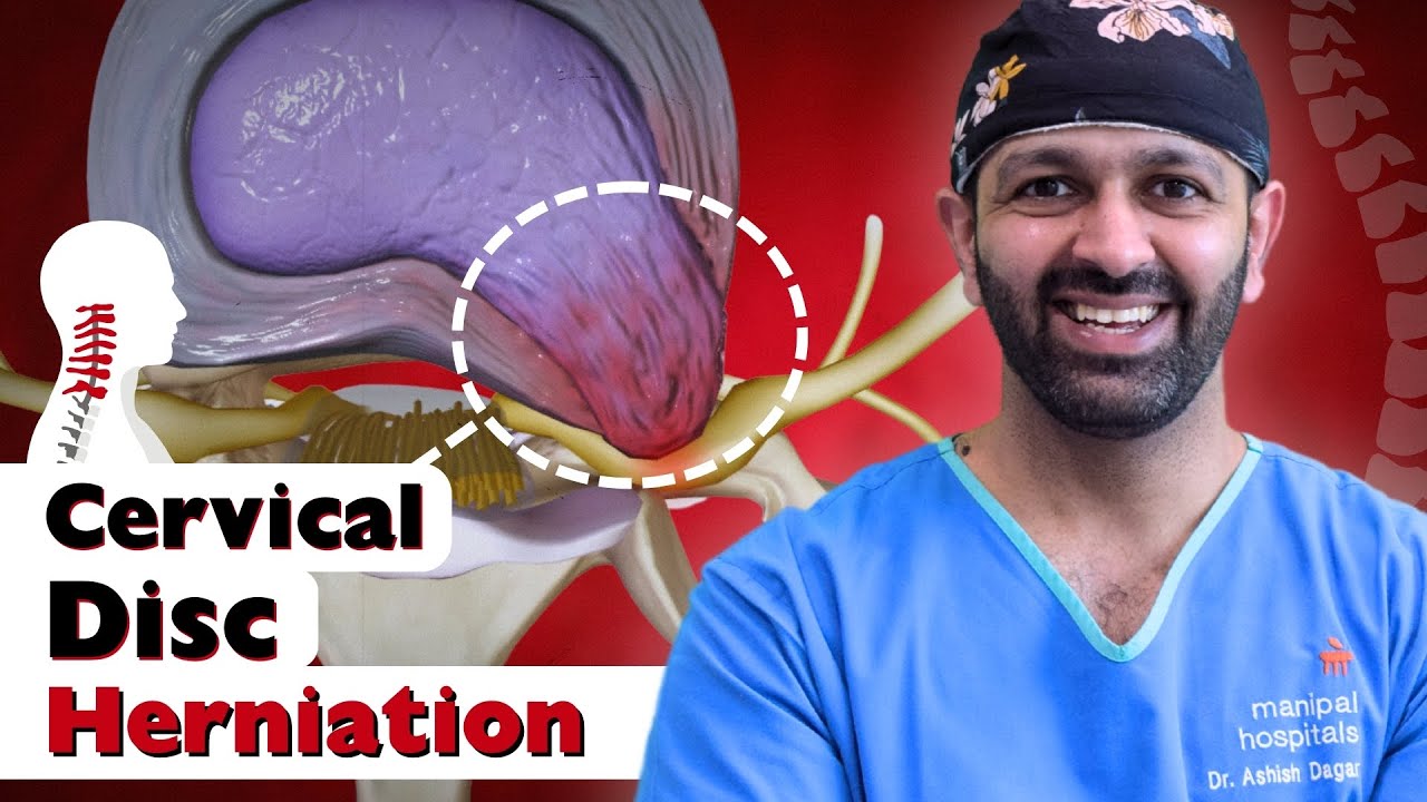 Cervical Disc Herniation Explained: Causes, Symptoms & Treatments - YouTube