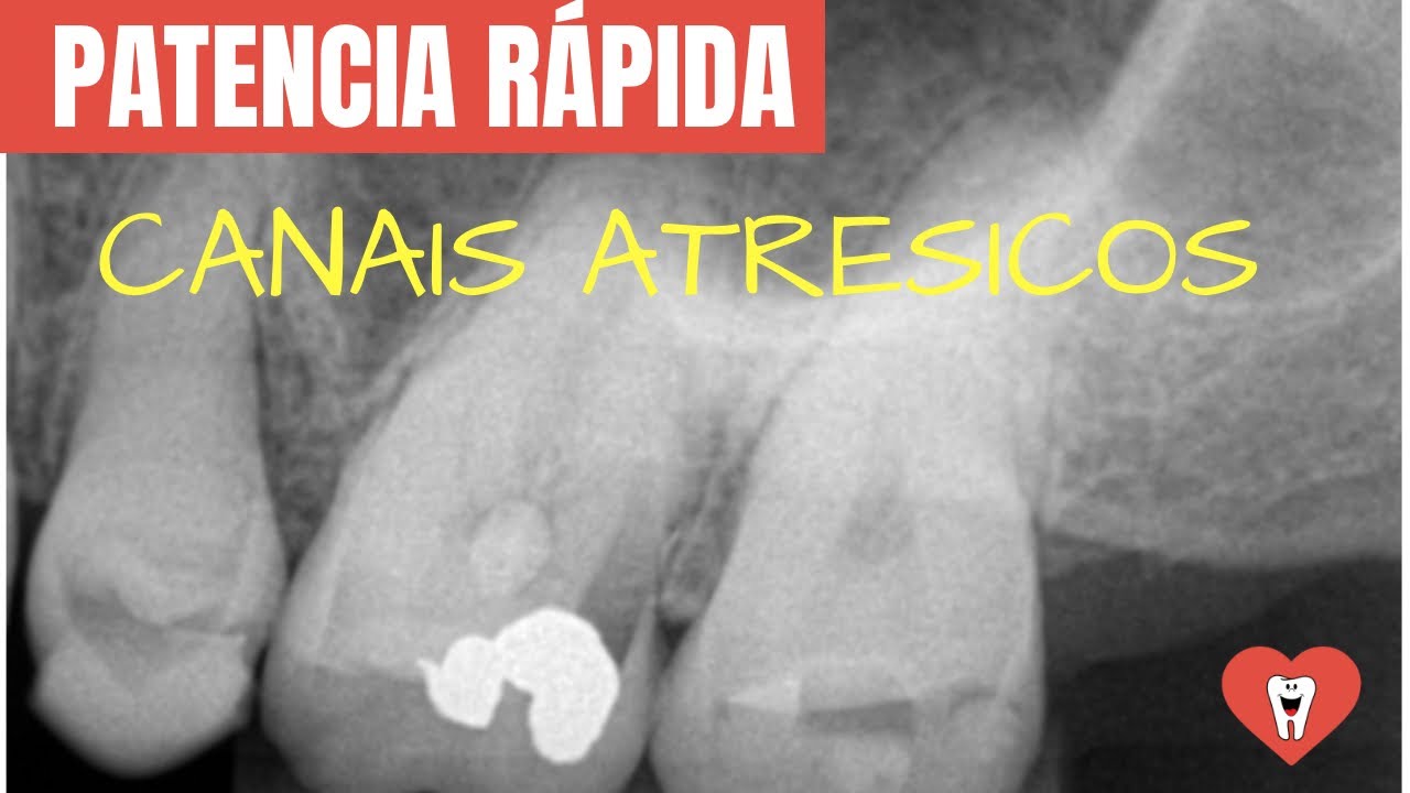 [SUPER DICA] COMO DAR PATÊNCIA MAIS FÁCIL E RÁPIDO EM CANAIS ATRÉSICOS ...