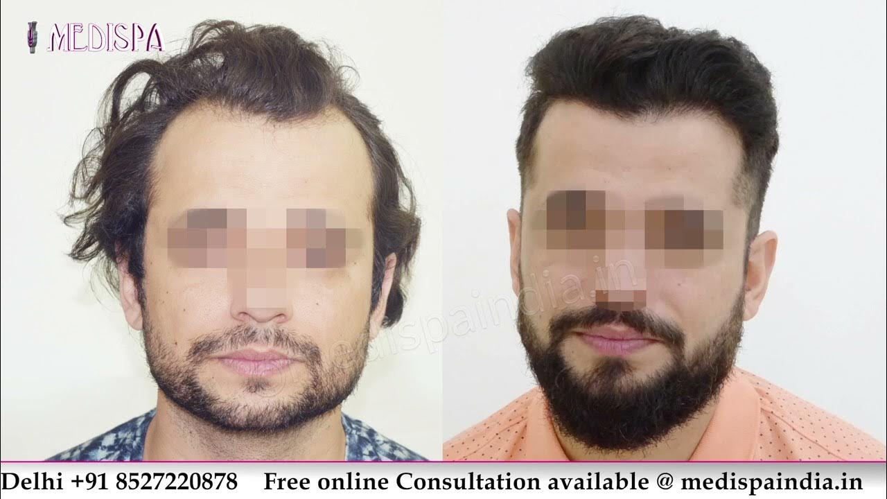 Best Hair Transplant Results You Must Watch Medispa India Dr Suneet