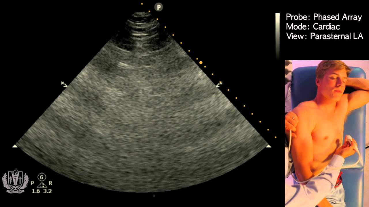 Parasternal Long Axis View - STEP by STEP Point of Care Ultrasound ...