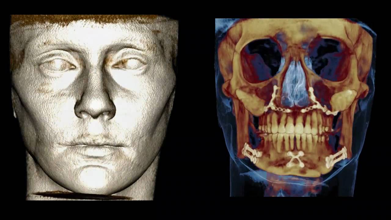 Niesamowity tomograf CBCT NewTom 5G i NewTom VGi - YouTube