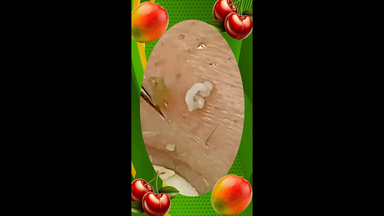 Blackheads Removal | Acne Treatment and Very Satisfying Satisfying ...
