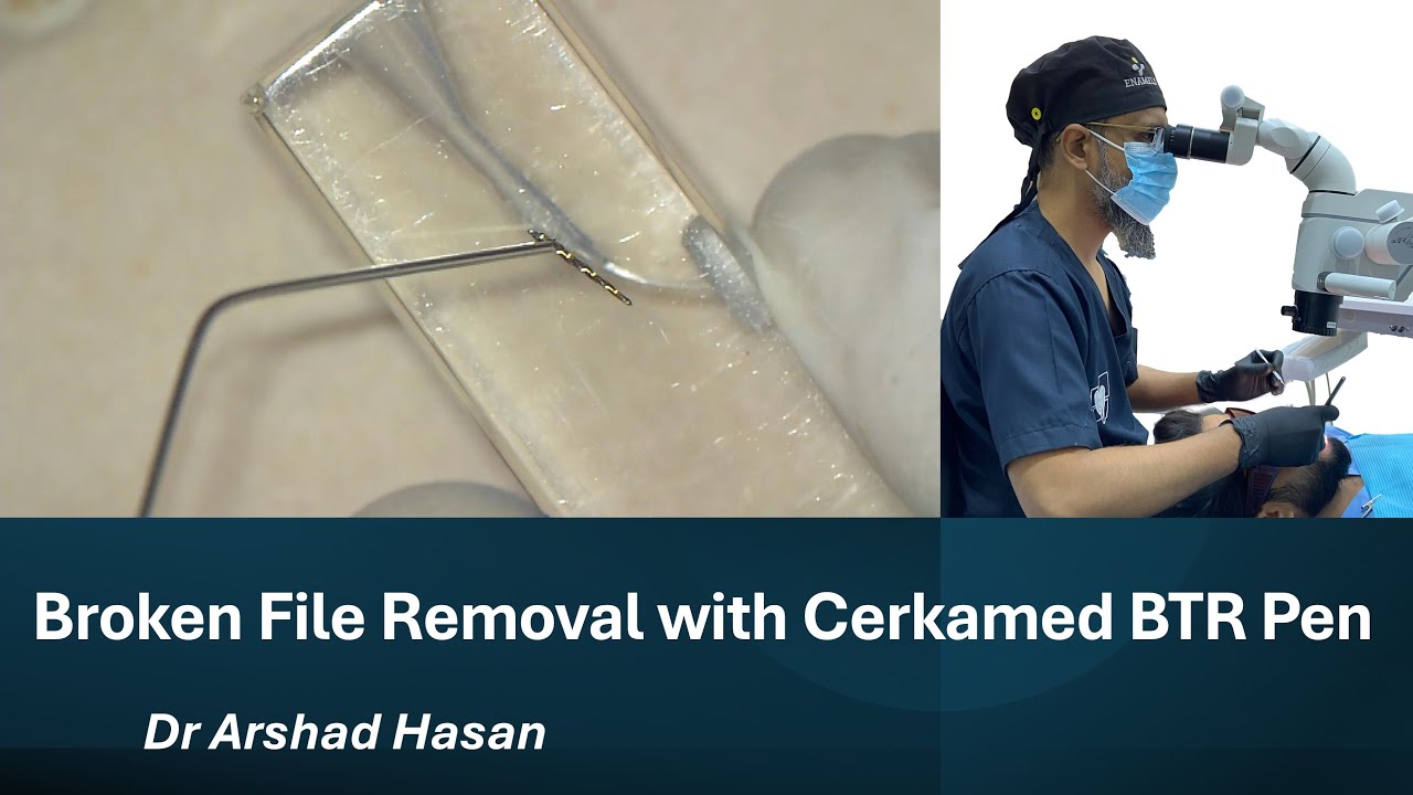 Broken File Removal With Cerkamed BTR Pen - YouTube