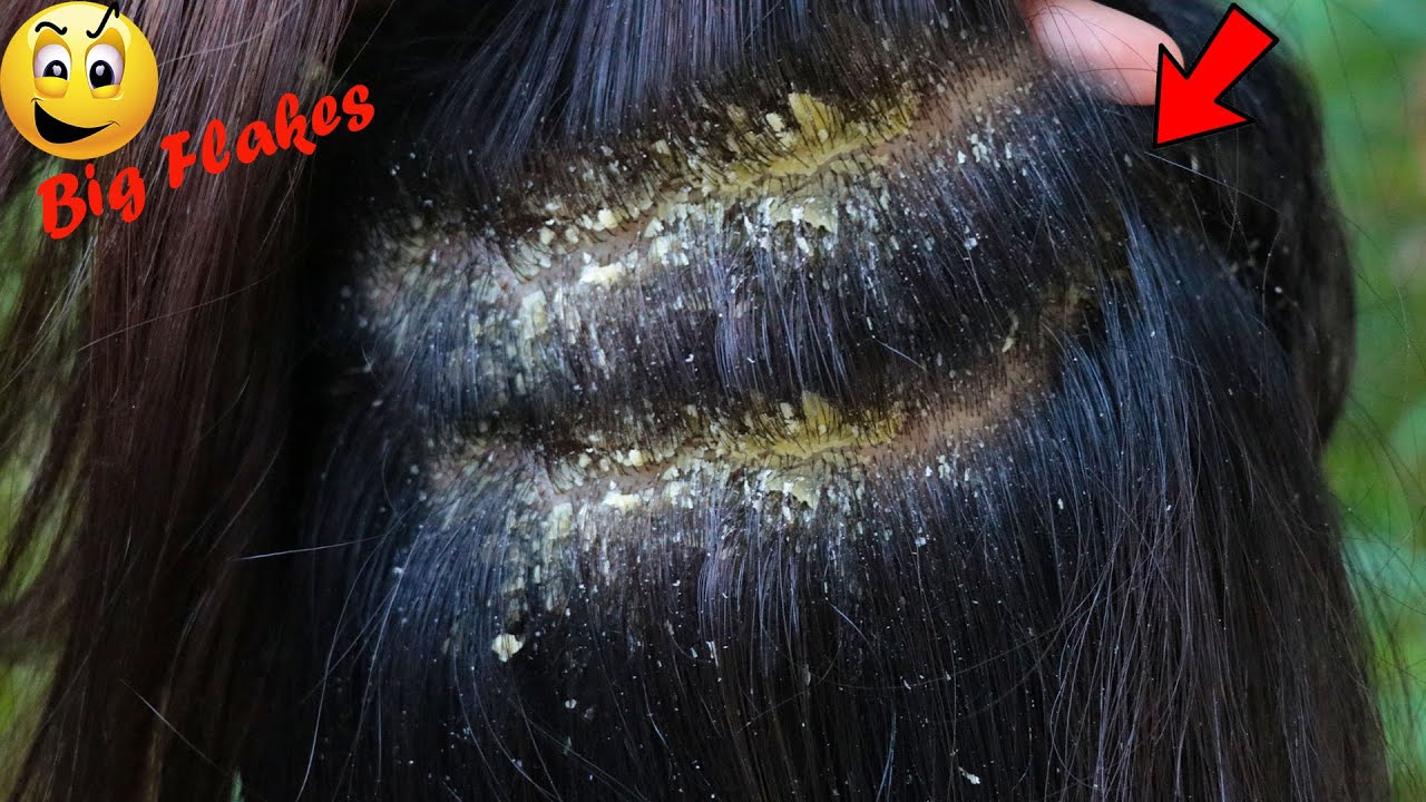 Scratching Itchy Scalp!! Itchy Dry Scalp Natural Hair Removal (Dandruff ...