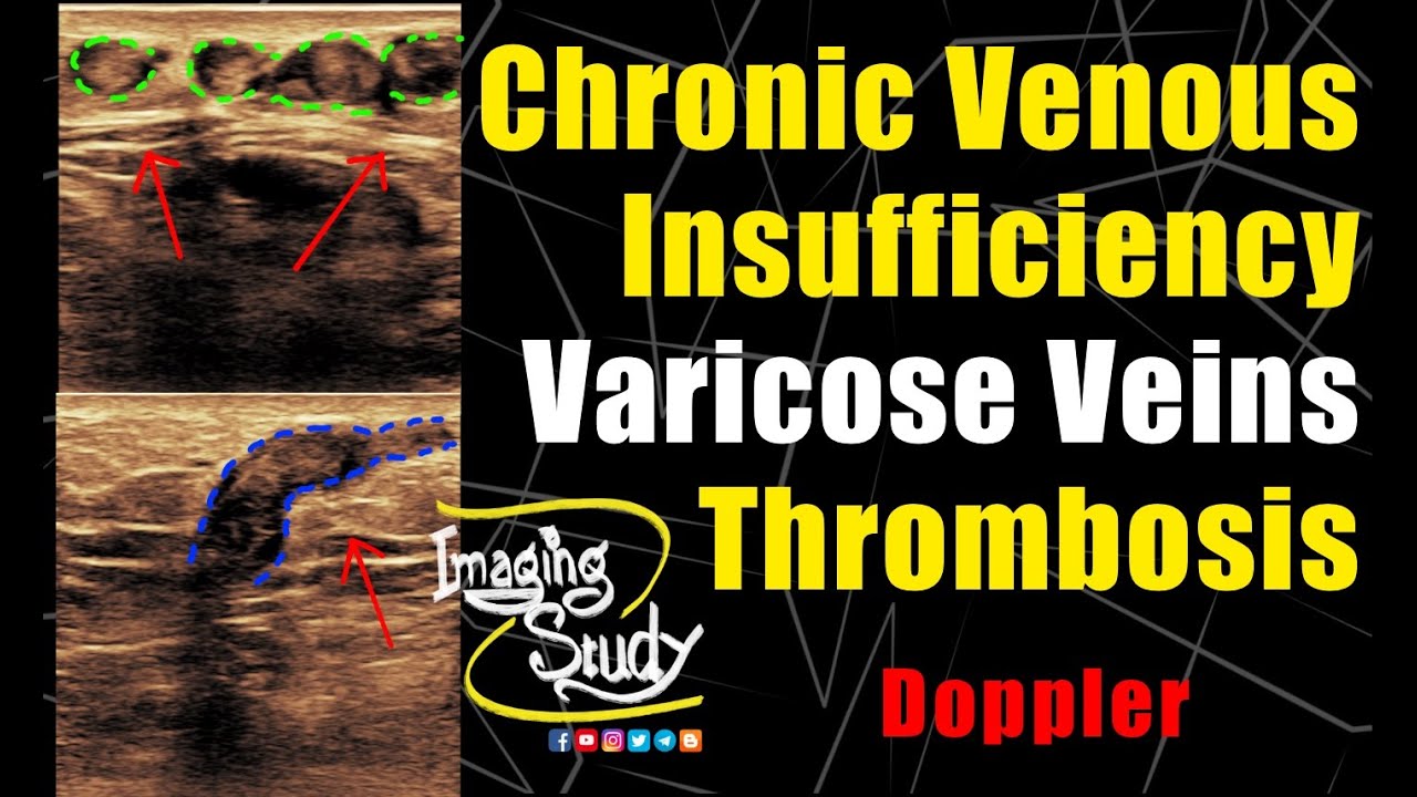 Chronic Venous Insufficiency - Varicose Veins - Thrombosis ...