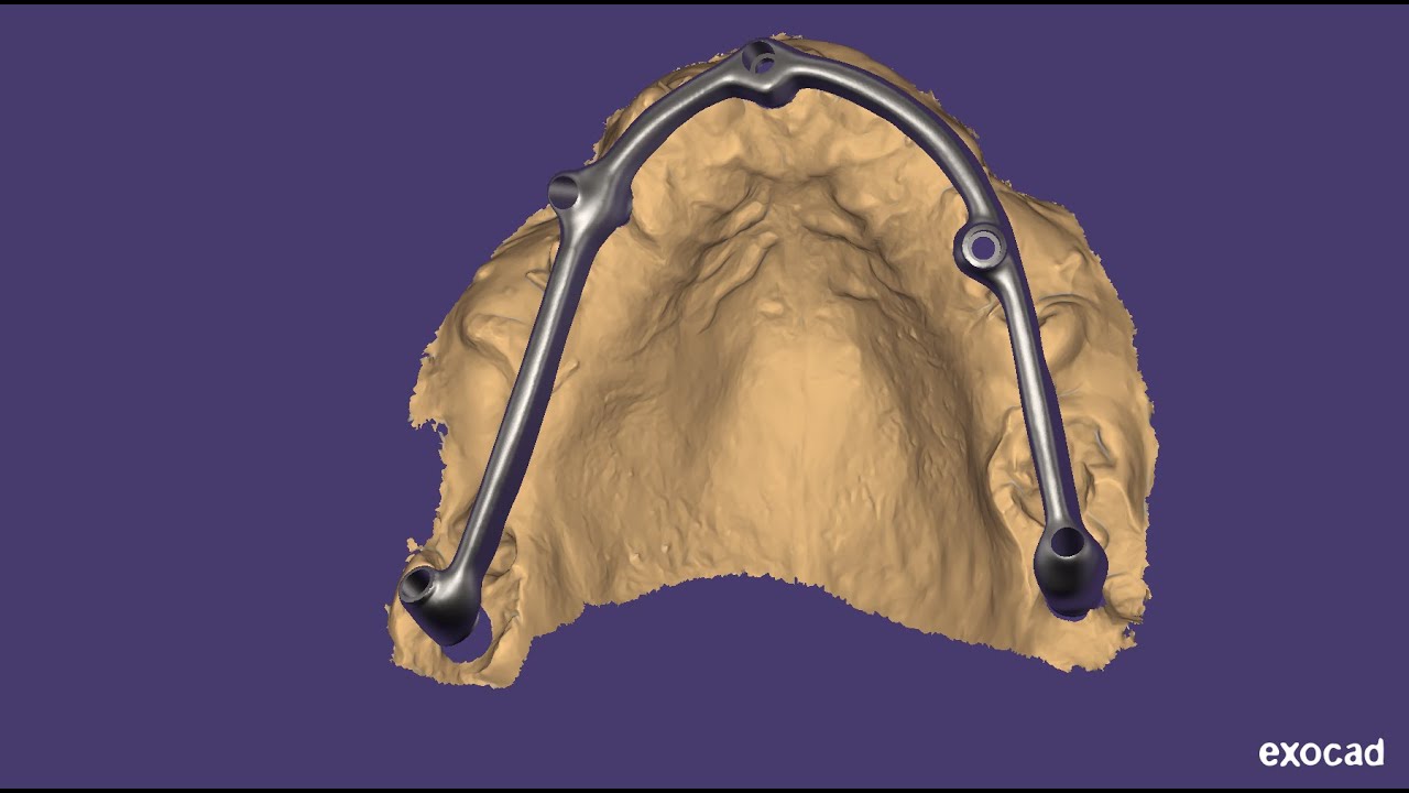 Titanium bar designing for upper mu screw retained implant in Exocad ...