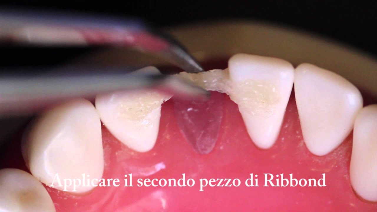 Ribbond - Ponte in 1 appuntamento / Splintaggio Parodontale - YouTube