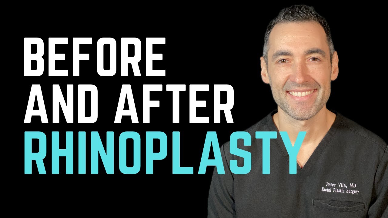 Rhinoplasty Before and After in Portland, Oregon with Dr. Vila ...