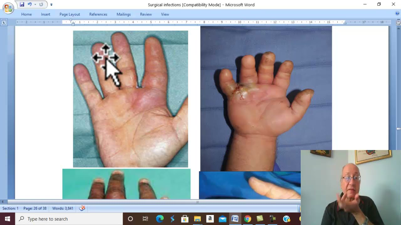 Surgical infections in English 6 ( Hand Infections, part 2 ) , by Dr ...