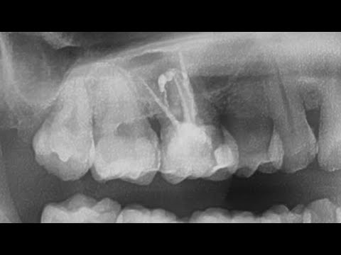 Root canal treatment on a distal caries. DME !!! - YouTube