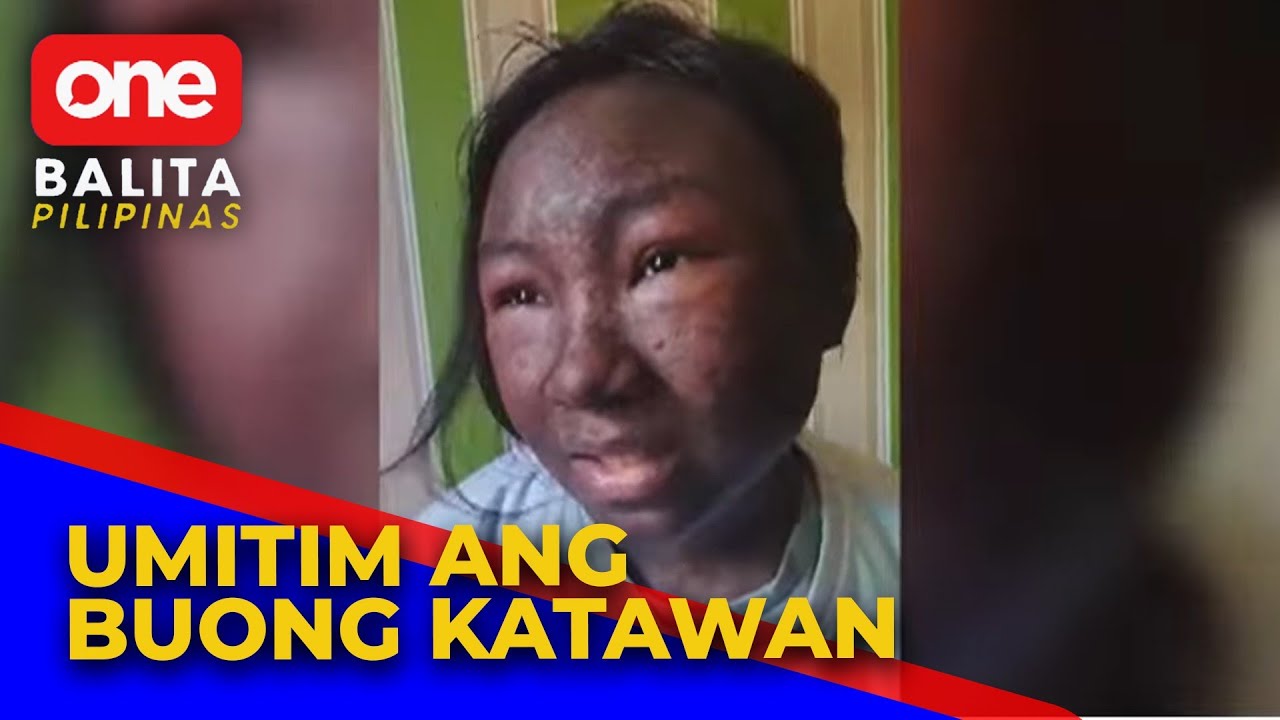 Dalagang nangitim ang katawan, malaman pa kaya ang karamdaman? - YouTube