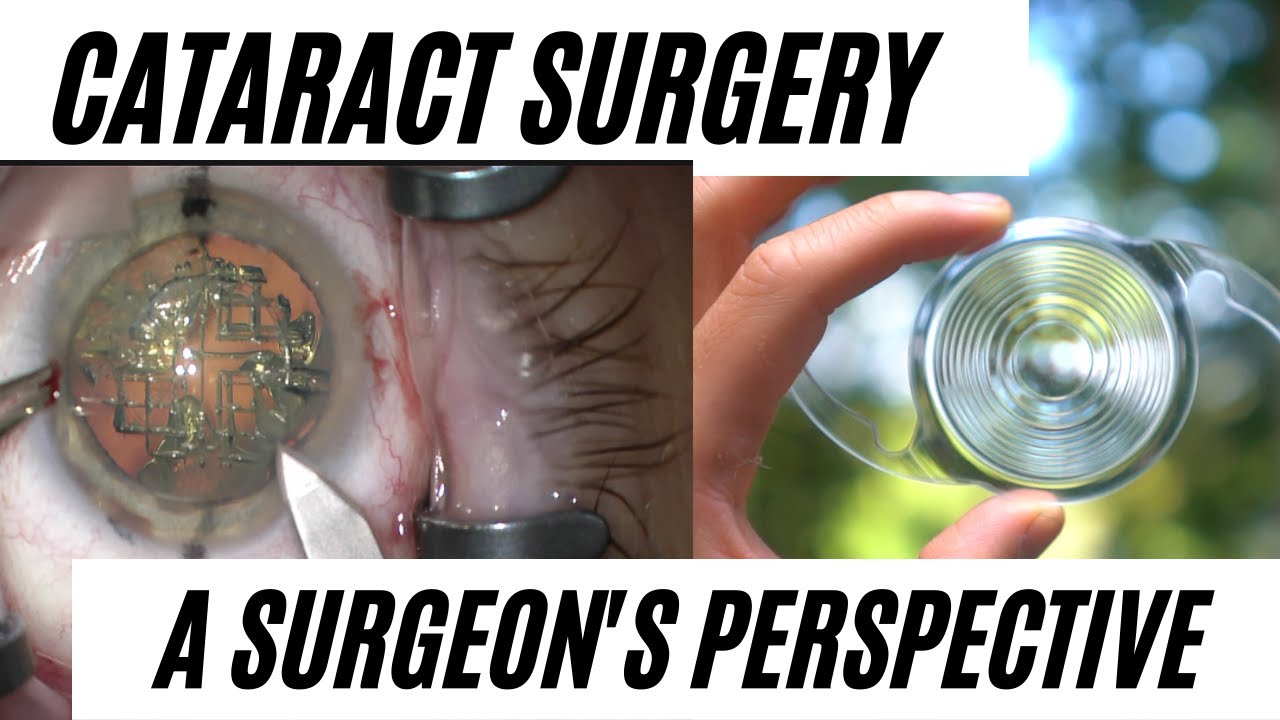 Cataract Surgery Simplified - A Surgeon's Perspective - YouTube