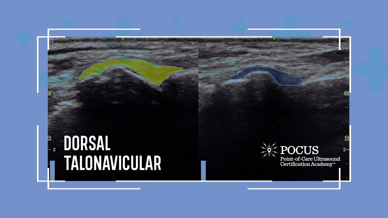 Dorsal Talonavicular Joint and Ligament - YouTube
