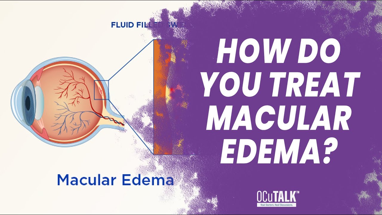 How do you Treat Macular Edema? - Dr. Lazar explains - YouTube