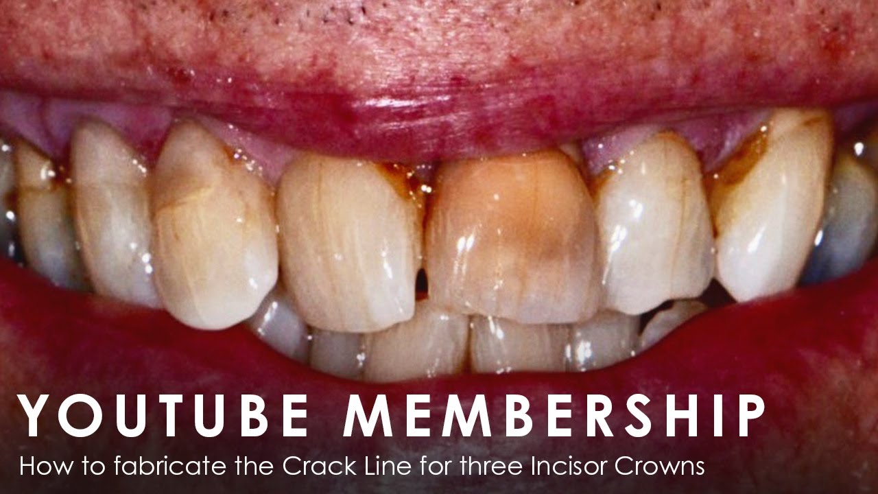 How to fabricate the Crack Line for three Incisor Crowns - YouTube