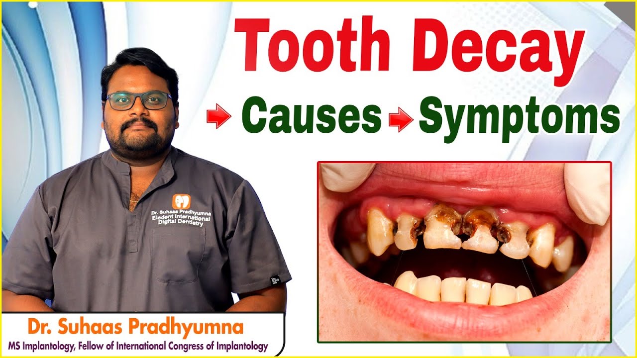 Early Signs of Tooth Decay || Tooth Decay Causes || Dr Suhaas ...