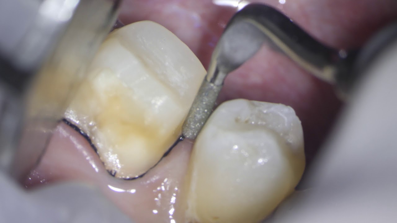 prosthetics preparation of a lower molar - YouTube
