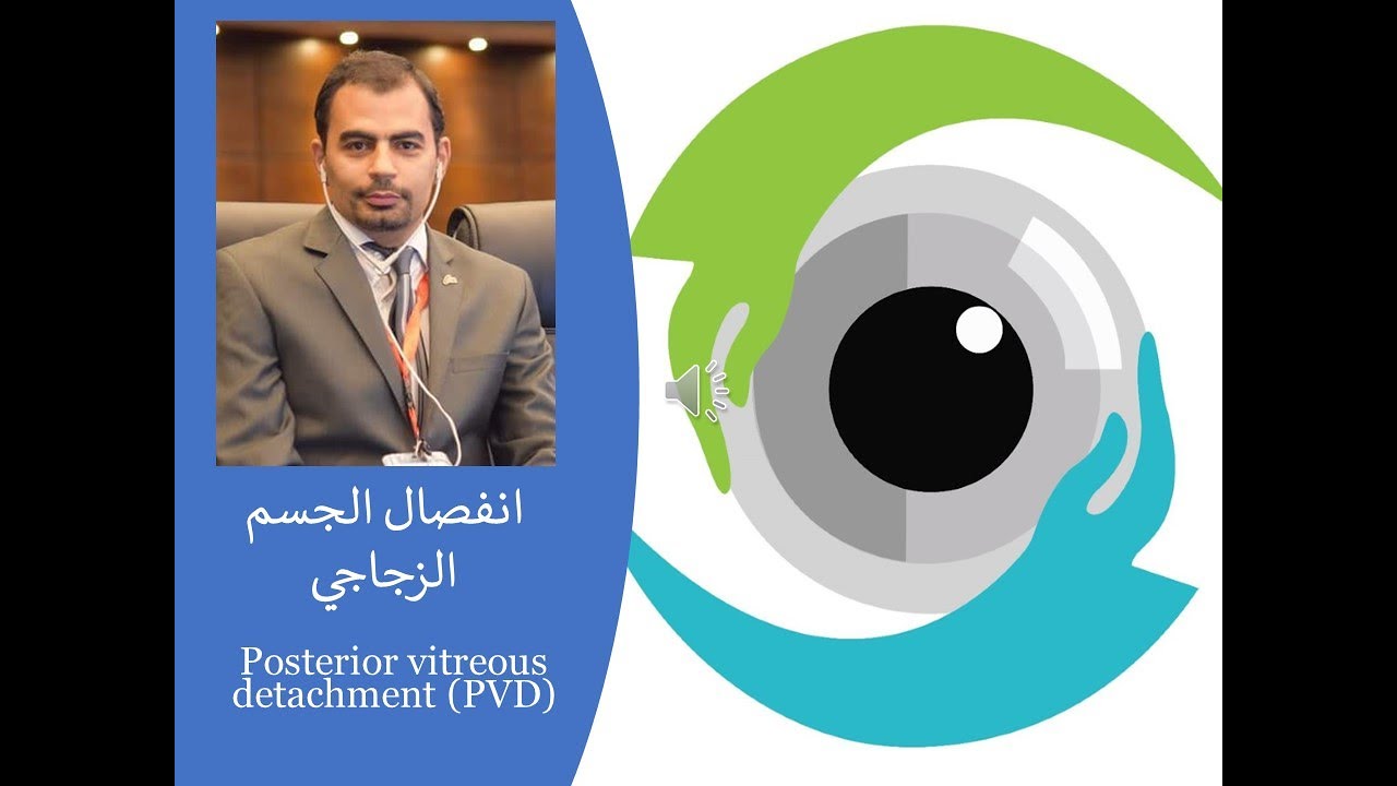 Posterior vitreous detachment PVD (Flashes and Floaters) انفصال الجسم ...