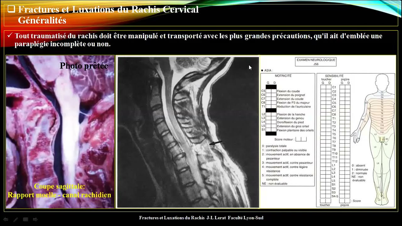 Traumatisme du rachis cervical 🤩 meilleure explication 🤩 par Pr Atia ...