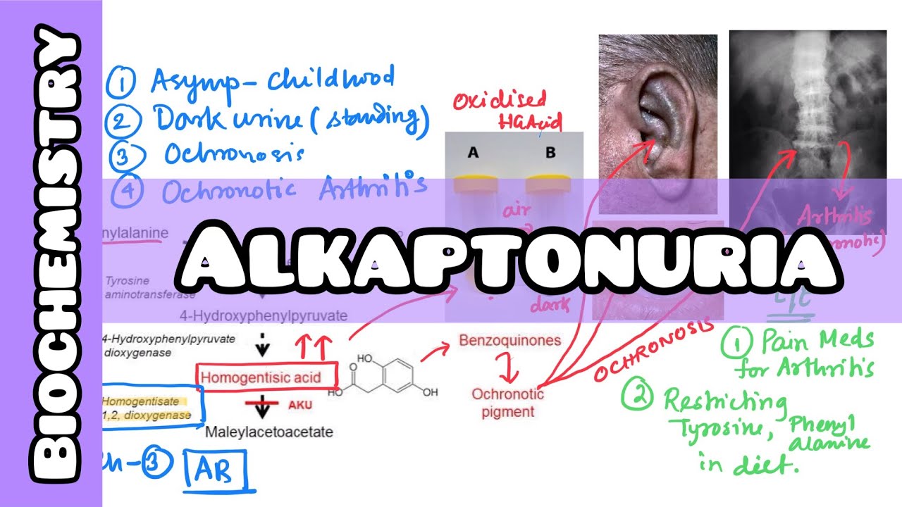 Alkaptonuria: the molecular biochemistry made simple for USMLE ,NCLEX ...