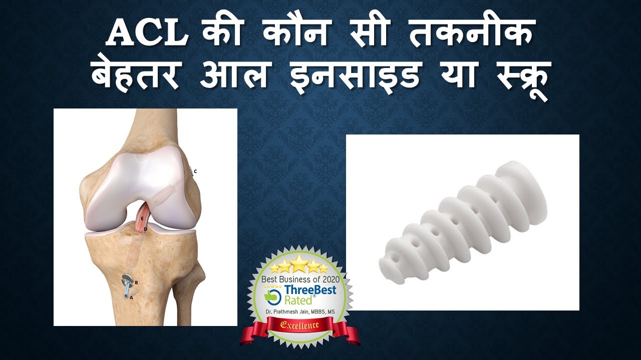 Which ACL Technique is better All inside acl or Screw - YouTube