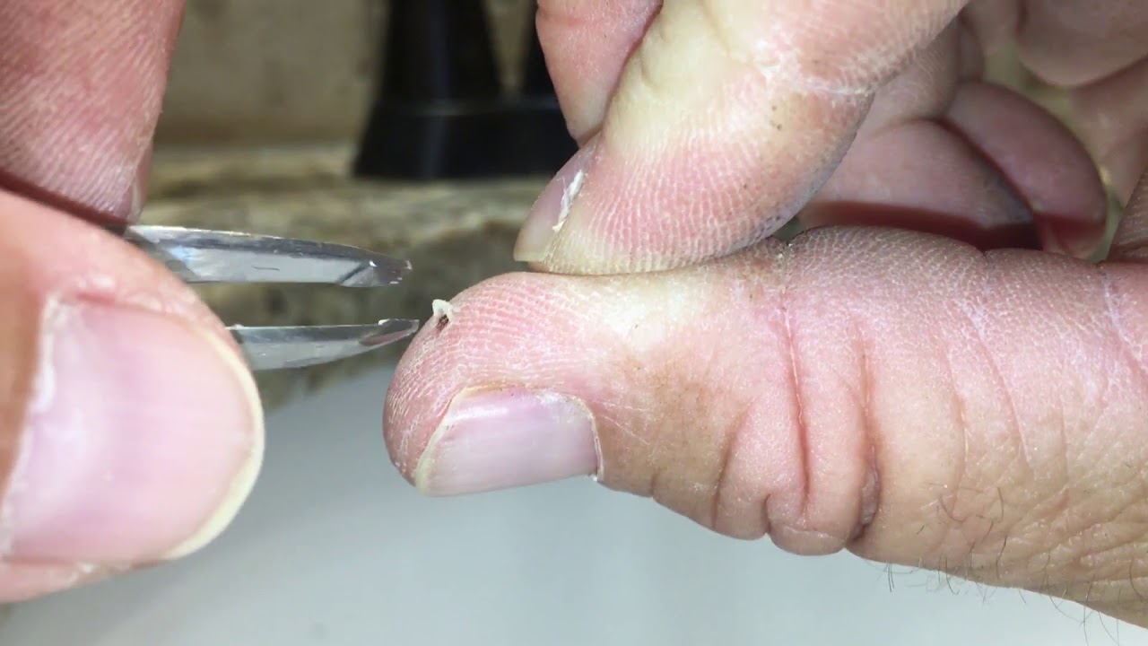 Pulling out a deep splinter. - YouTube