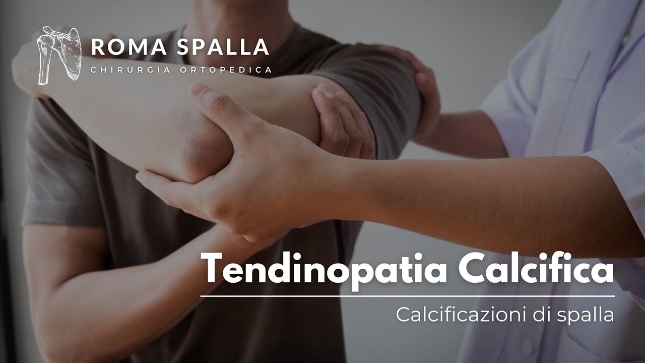 Roma Spalla Tendinopatia Calcifica - YouTube