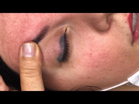 Eyeliner 1 Seans Silme Sonrası