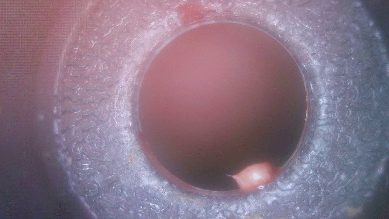 Chunky chunky chin pimple - YouTube