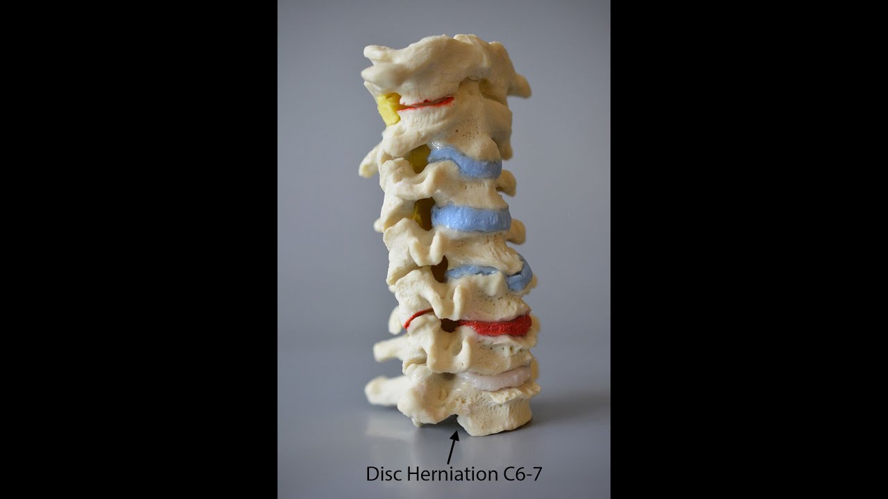 Cervical Movement with a Dynamic Disc Designs Model - YouTube