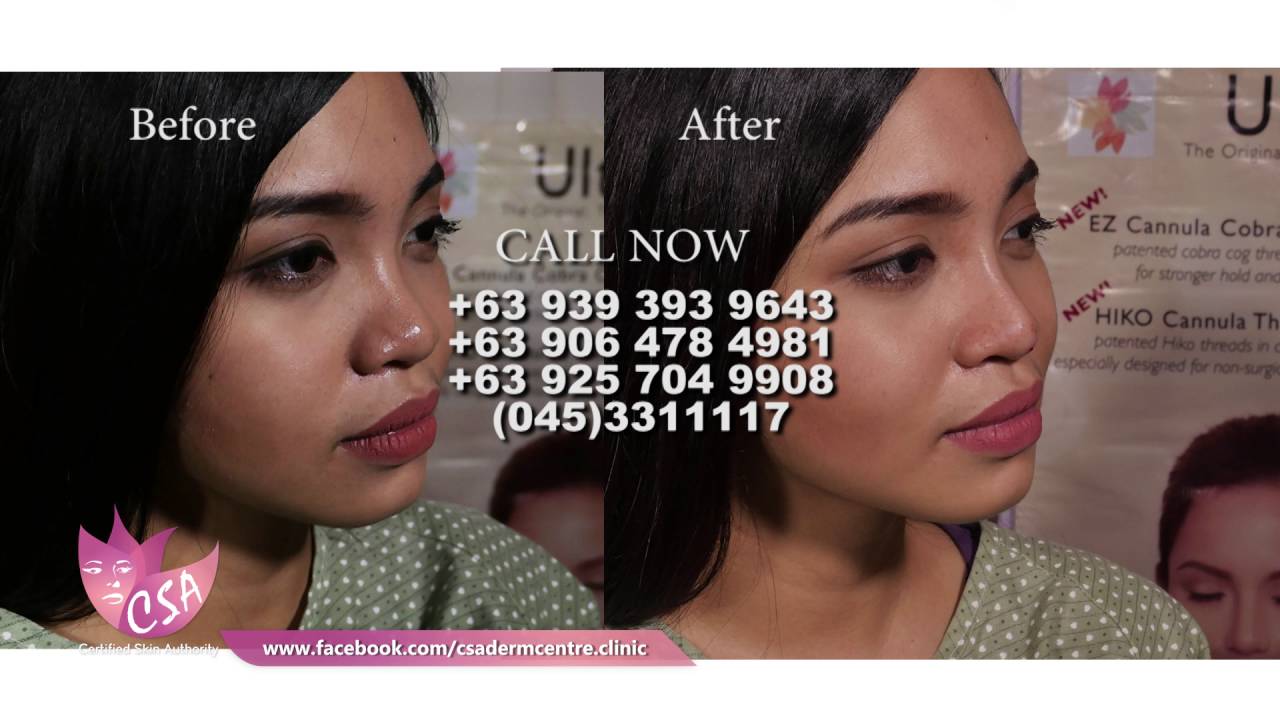Eyebag treatment using threads - YouTube