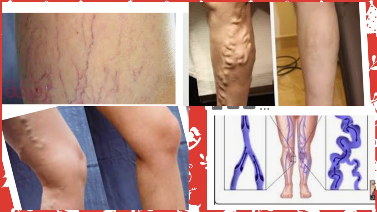 مشكل الدوالي les varis - YouTube