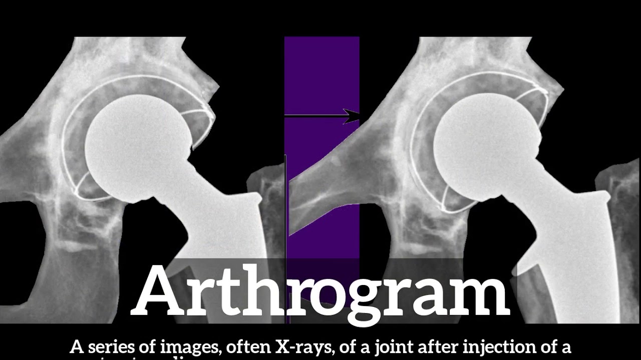 How to Say Arthrogram in English? | How Does Arthrogram Look? | What is ...