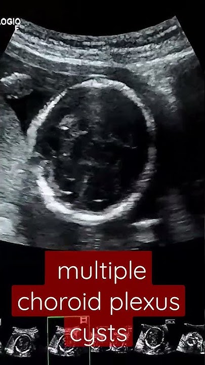 fetal choroid plexus cysts - YouTube