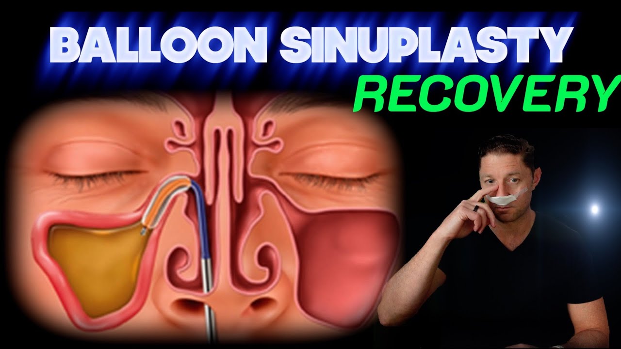How Long Does It Take To Recover From Balloon Sinuplasty Surgery - YouTube