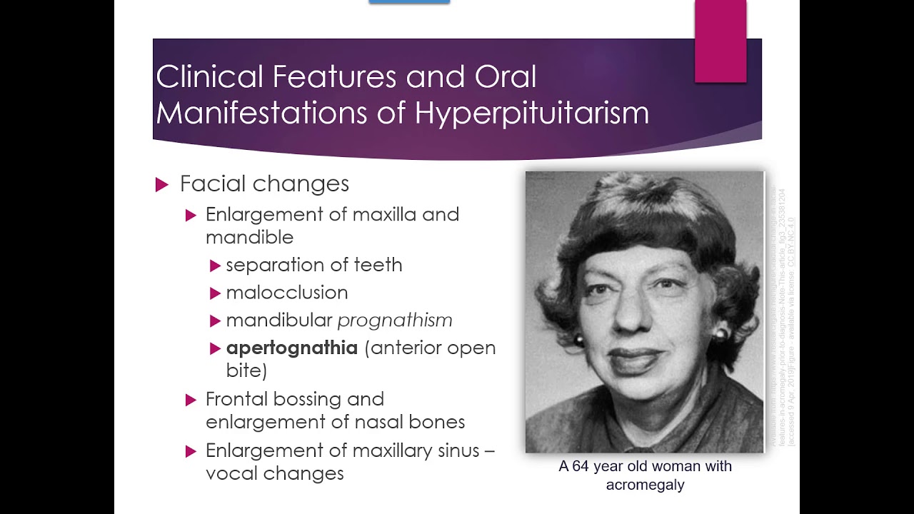 Chapter 9 Part 2_ Hyperpituitarism - YouTube