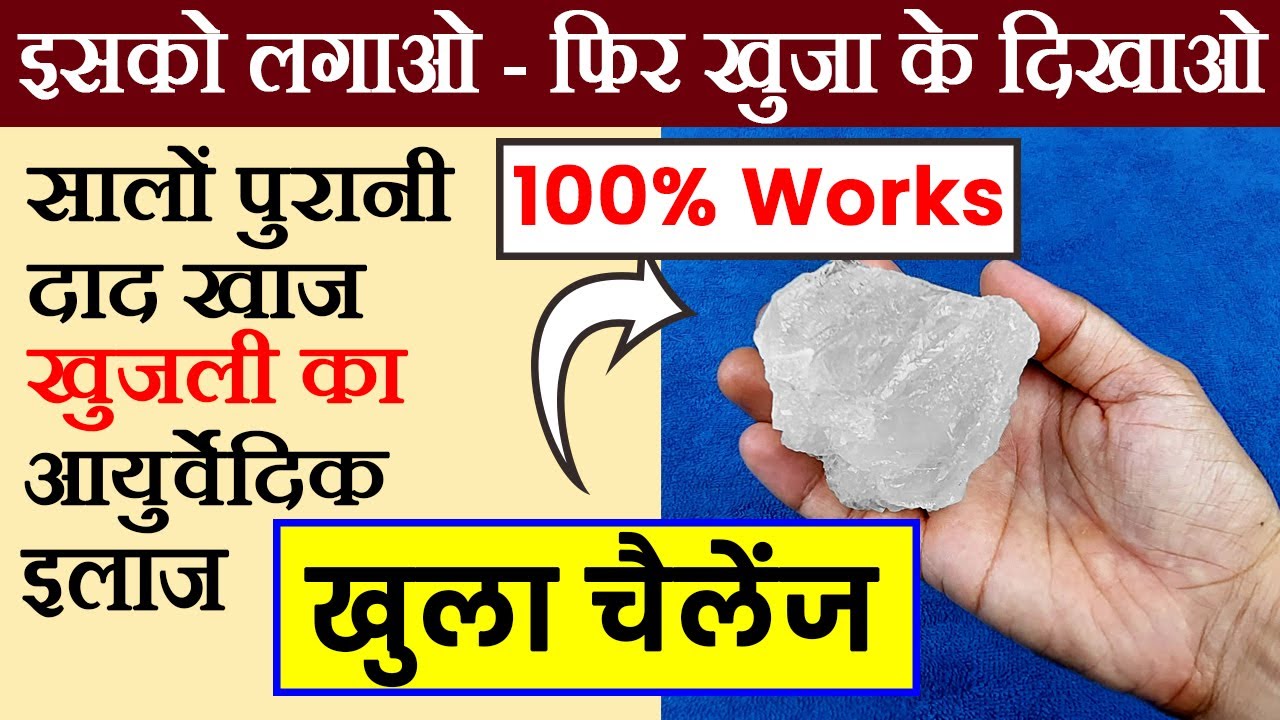 Khaj Khujli Ka ilaj, खाज खुजली के लिए घरेलू नुस्खा, khujli ki dawa, How ...