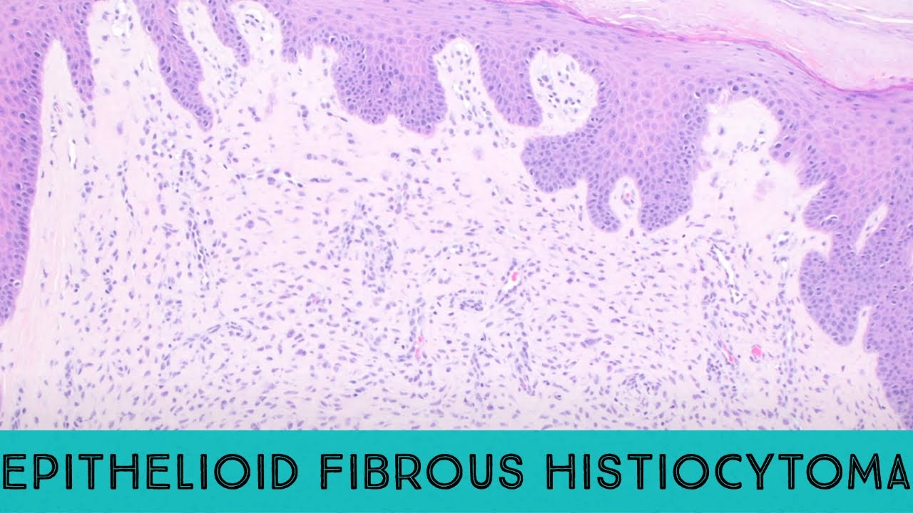 Epithelioid fibrous histiocytoma (benign ALK1+ skin tumor; ALK gene ...